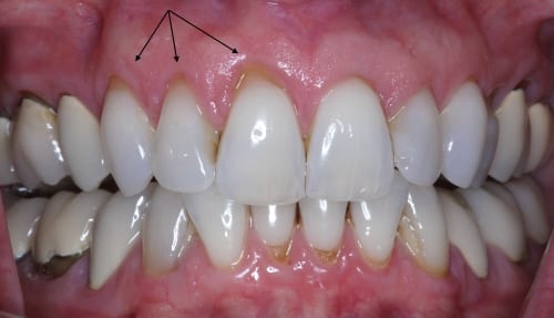 Connective Tissue Grafting for Root Coverage | Tampa, FL | Tampa Bay ...