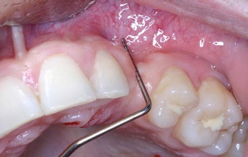 Extraction With Ridge Preservation | Tampa, FL | Tampa Bay Periodontics ...