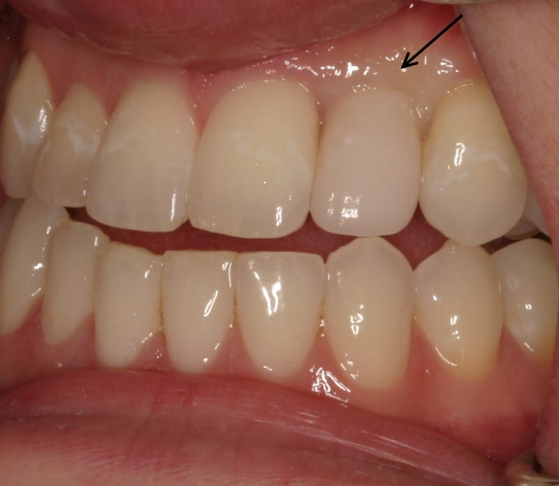 Ridge Augmentation Bone Grafting | Tampa, FL | Tampa Bay Periodontics ...