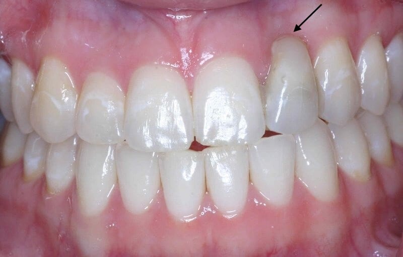 Ridge Augmentation Bone Grafting | Tampa, FL | Tampa Bay Periodontics ...